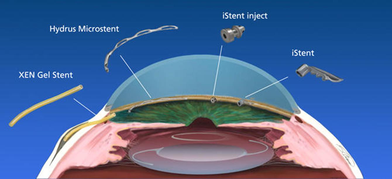Minimally Invasive Glaucoma Surgery | Consultant Ophthalmic Surgeon Minimally Invasive Glaucoma Surgery | Consultant Ophthalmic Surgeon